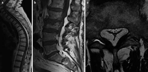 19 A C Epidural Lipomatosis On T1wi Often Seen In Overweight