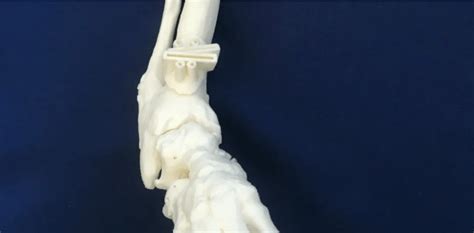 3d 打印在骨科手术中有哪些进展看完你就知道了！应用