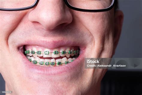 中かっことブラケットを歯歯の矯正の教室配置の Stamotology 1人のストックフォトや画像を多数ご用意 1人 エナメル