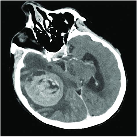 Preoperative Axial Brain Ct Angiogram Showing A Well Defined Right