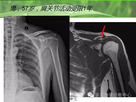 X线片怎么诊断肩周炎看看这篇 好医术早读文章 好医术 赋能医生守护生命