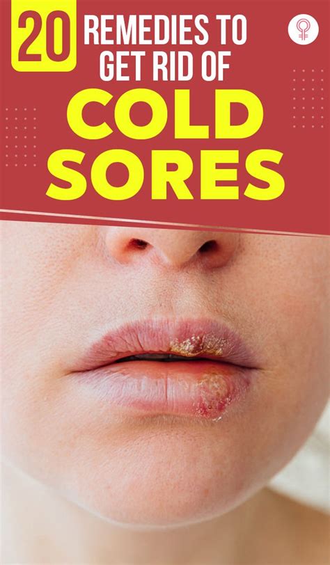 20 Home Remedies To Get Rid Of Cold Sores And Prevention Tips Artofit