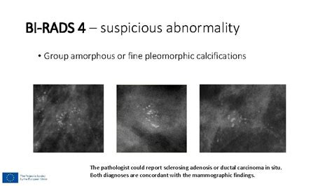 Birads Classification In Mammography Dr Egle Jonaitiene Dr