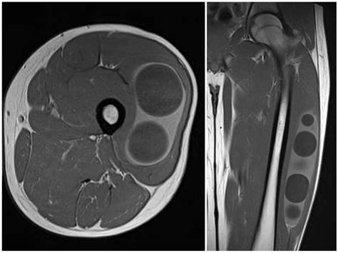 Radiology Signs Mri Of The Thigh What Are These