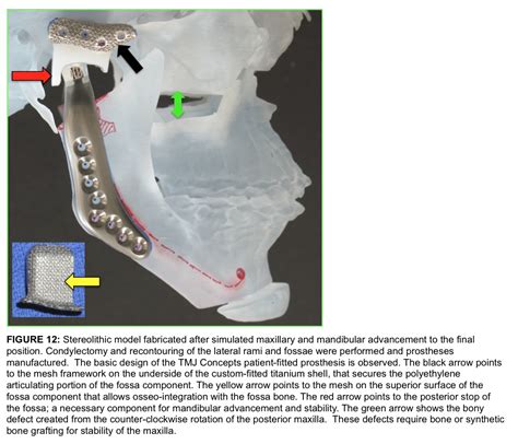 Total Tmj Replacement Dr Larry M Wolford Dmd
