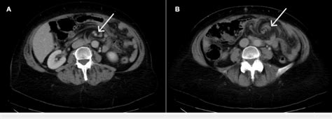 Ct Abdomen And Pelvis Axial The Mesenteric Swirl Sign Indicative Of