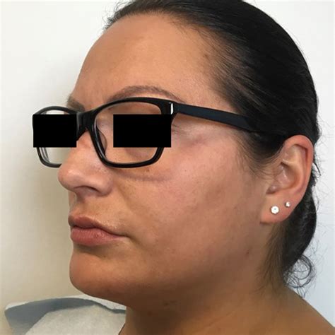Chin Implant Before And After 03 Dr Sajan