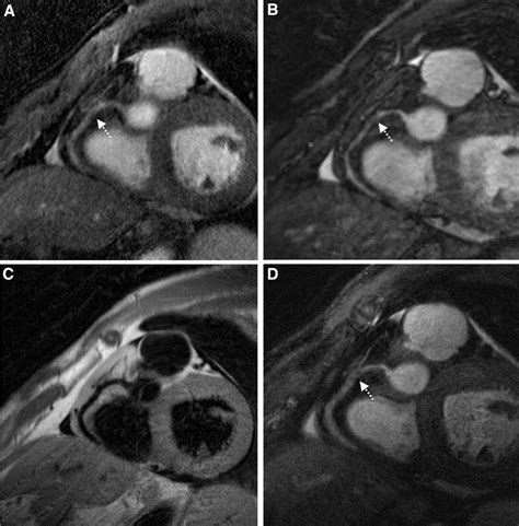 Pitfalls In Coronary Magnetic Resonance Angiography Circulation