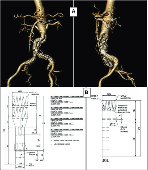 A Three Dimensional Reconstruction Of 10 Year Follow Up Computed Download Scientific Diagram