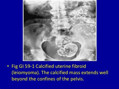 59 Female Genital Tract Calcification
