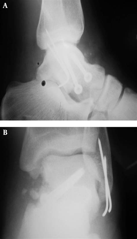 Internal Fixation Of Left Talus Neck With Medial Wall Comminution And
