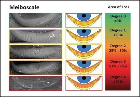 Framed Canvas Meibomian Gland Grading Scale 3 Frame Colors