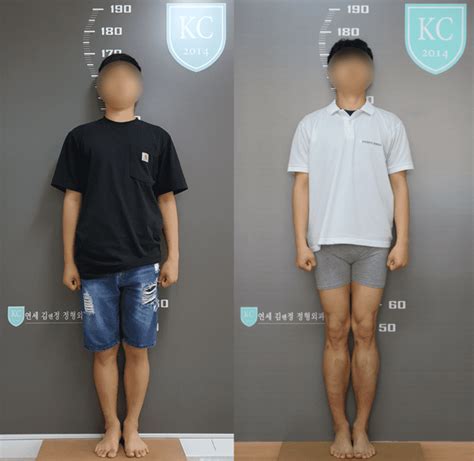 Limb Lengthening Surgery Before And After Photos Limb Lengthening