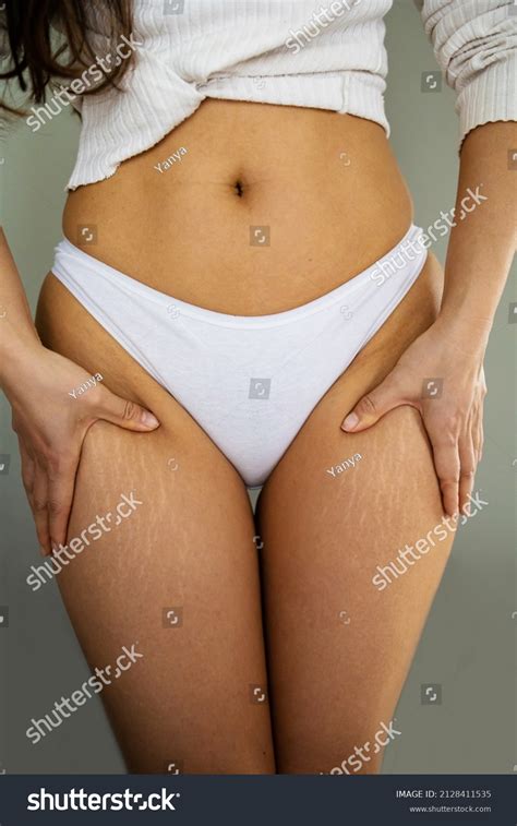 Stretch Marks On Female Legs Images Stock Photos Vectors