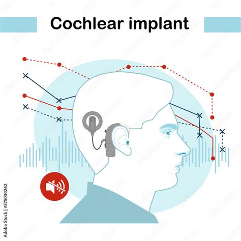 Head With A Cochlear Implant Device In The Ear Cochlear Implant Device