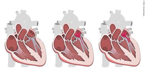 Mitral Valve Repair Surgery Or Interventional Treatment