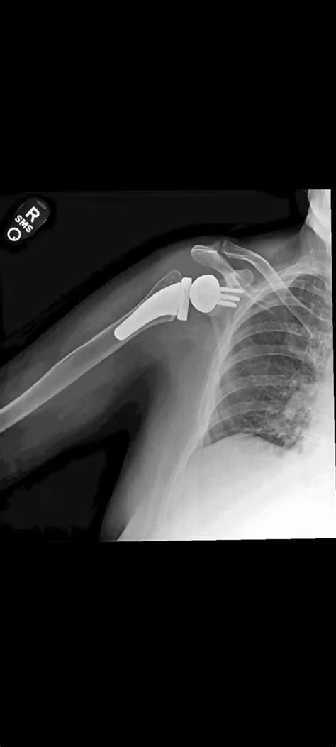 Shoulder Replacement Surgery In Jaipur Jaipur Ortho