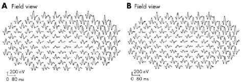 Trace Arrays Of Patient 2 Showing Reduced Amplitude In The Central