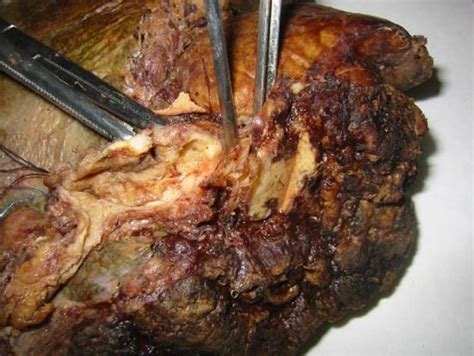 Cholangiocarcinoma Gross