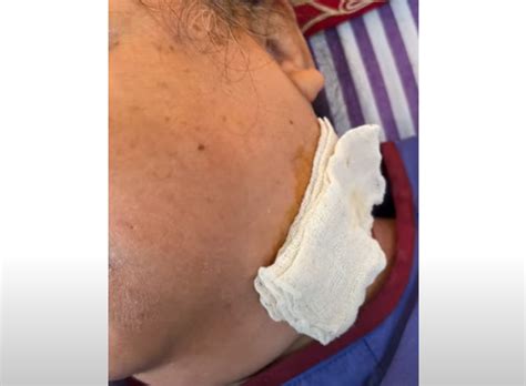 Masseteric Space Abscess Drainage Archives New Pimple Popping Videos
