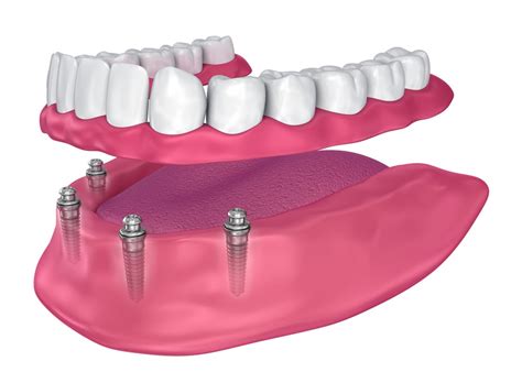 Implant Supported Overdenture Premier Oral Surgeon In Johns Creek