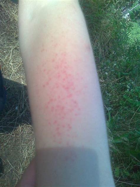 წითელი ლაქები სხეულზე თბილისის ფორუმი