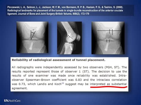 Assessment Of Femoral Tunnel Placement In Acl Reconstruction