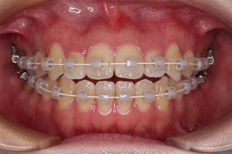 舌突出癖による開咬 舌のトレーニングを行いながら前歯の隙間を改善｜（医）精密審美会
