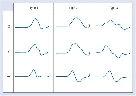 P Waves