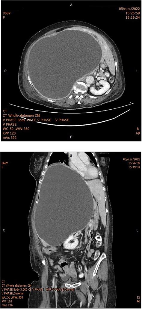 Whole Abdomen Enhanced Ct Showed A Huge Hepatic Cyst Occupying The