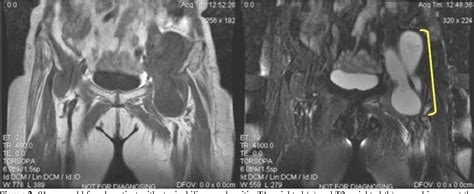 Iliopsoas Bursitis Mri