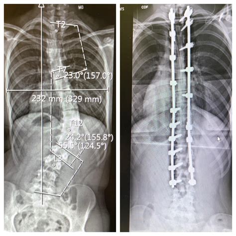 My Spinal Fusion Scoliosis My Xxx Hot Girl