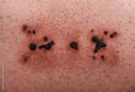 Pox Smallpox Mpox Pathogen Bacteria Biotechnology Bacterium