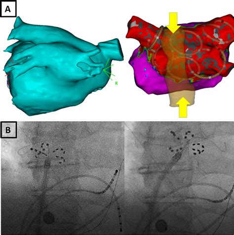 A Left Computer Tomography Generated Segmentation Of The Left Atrium
