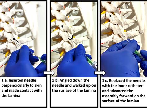 Retrolaminar Continuous Nerve Block Catheter For Multiple Ri Aanda Practice