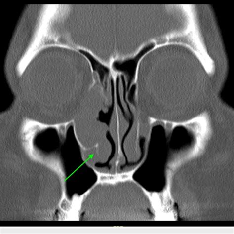 Mri Showing Recurrent Tumor Extending From The Frontoethmoidal Recess Download Scientific