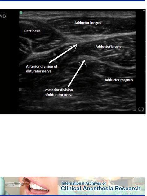 Attenuation Of Adductor Spasm By Ultrasound Guided Obturator Nerve Block For Turbt Pdf Download
