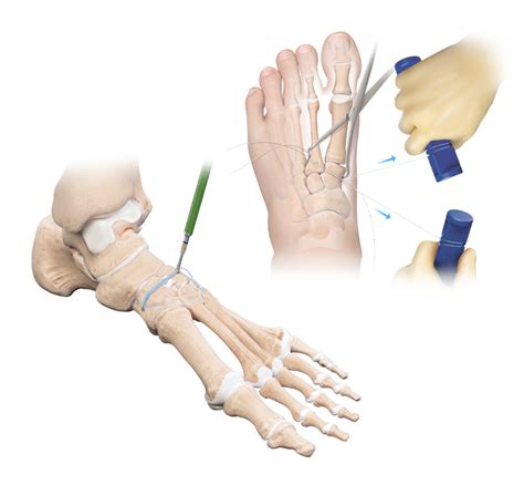 How To Fix Lisfranc Fracture At Jasper Gunson Blog