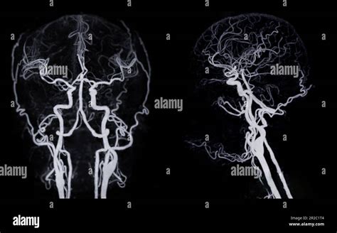 Ct Angiography Of The Brain Or Cta Brain Showing Cerebral Artery Stock