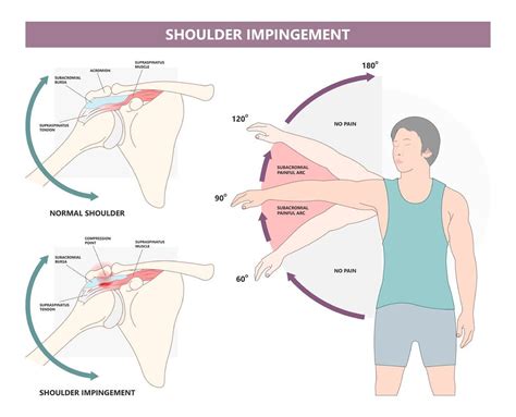 Scapular Dyskinesia Rehabilitation Shoulder