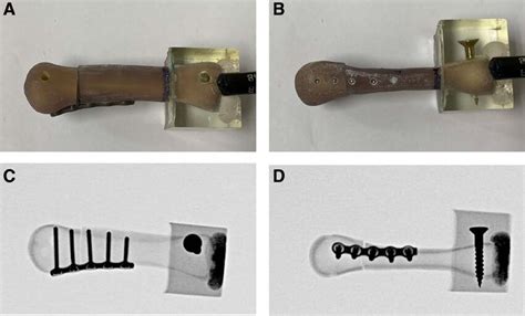 Artificial Metacarpal Bones And Bone Plate Fixation On The Volar Side Download Scientific
