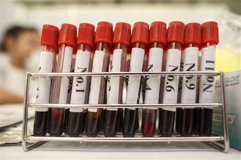 New Blood Test Detects Early Stage Ovarian Cancer With 90 Percent