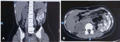 Figure 1 From A Rare Case Of Sarcomatoid Renal Cell Carcinoma In A