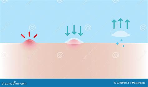 Acne Pimple Patch For Papule Vector Illustration On Blue Background