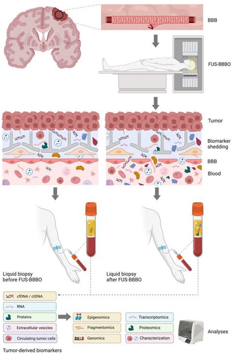 Focused Ultrasound Enhanced Liquid Biopsy A Promising Diagnostic Tool For Brain Tumor Patients