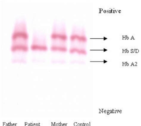 Hemoglobin D Disease Semantic Scholar