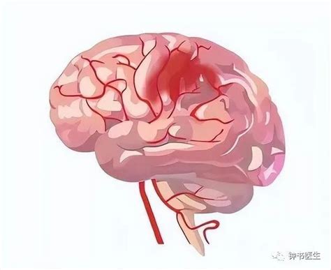 【脑科科普】来看看你是脑出血危险人群吗？ 脑医汇