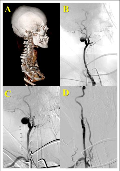 Figure 1 From Trans Cervical Endovascular Management Of Saccular