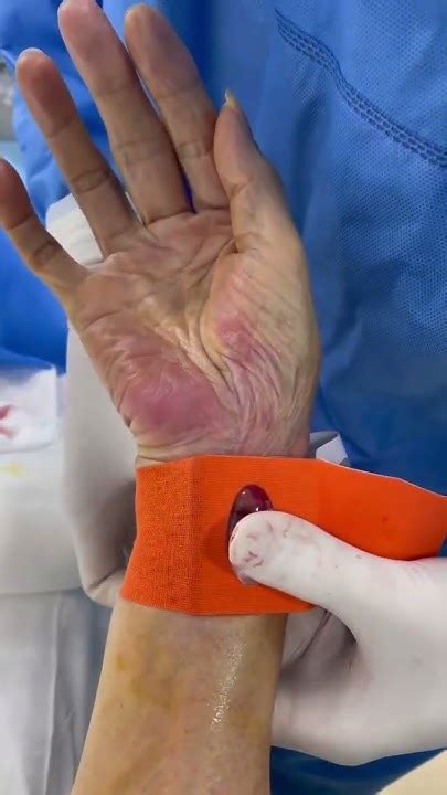 Demonstration Radial Hemostasis Compression Device Tr Band Radial