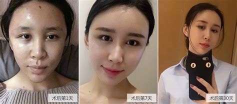 面部自体脂肪填充多少钱 上海美莱整形医院